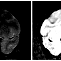 Example of T2-weighted (left) and SWI (right) MR images corresponding ...
