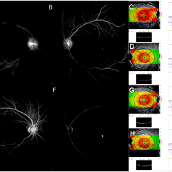 The representative case of Behçet uveitis in a 3*-year-old male patient.