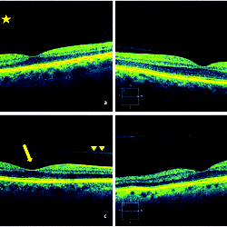 SD-OCT-images of different degenerative posterior vitreous changes.