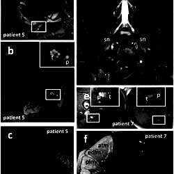 Localization and fascicular distribution of T2-nerve lesion, and ...