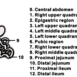 Illustration of Peritoneal Cancer Index (PCI) by Sugarbaker.