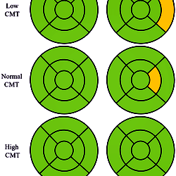 Early Treatment Diabetic Retinopathy Study subfield maps with color ...