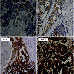 The co-expression of all HER family members in a patient with Dukes’ C ...