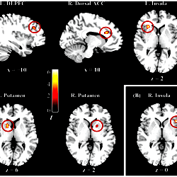 Brain regions showing decreased activities in patients compared with ...