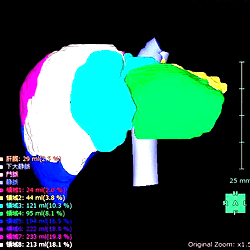 Volume calculation using SYNAPSE VINCENT.