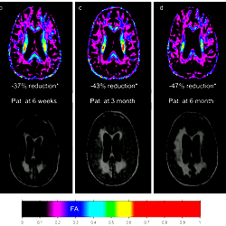 Color-coded FA map and FLAIR MRI of a 78 y old healthy control (a).
