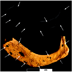 Item - Lytic lesions in the first rib. - figshare - Figshare