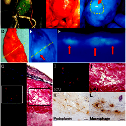 Fluorescence lymphography and microscopy of abdominal aortic aneurysm.