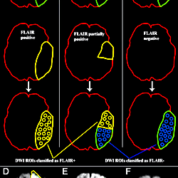 Labeling of lesions in DWI imaging according to the FLAIR pattern.