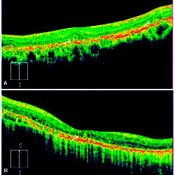 Item - Spectral domain-optical coherence tomography (SD-OCT) image of ...