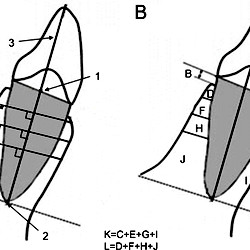 Morphological analysis of the alveolar bone of the anterior teeth in ...