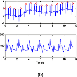 Successfully detecting the R-wave peaks in different patterns using our ...