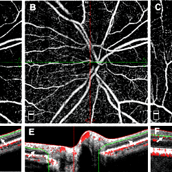 Optical coherence tomography angiography (OCTA) segmentation of the ...