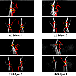 Illustration of the automatic PC-MRI scan positioning shown on 2D MIP ...