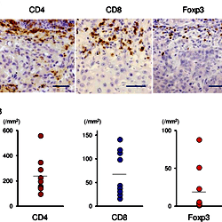 Immunohistochemical staining for CD4+, CD8+ and Foxp3+ TILs.