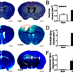Brain injuries produced by intraventricular hemorrhage (IVH), cortical ...