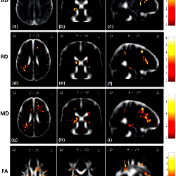 Group comparisons of the DTI indices between patient and control groups ...
