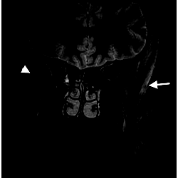 Coronal STIR MRI demonstrating bilateral asymmetrical high signal in ...