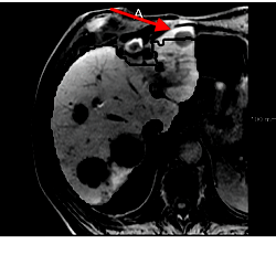 Most common error types of the Liver-Net approach.