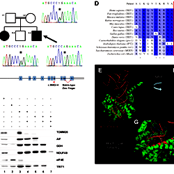 A TRIT1 mutation segregates with disease and disrupts a conserved tRNA ...