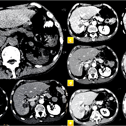 Yttrium-90 trans-arterial radioembolization in advanced-stage HCC: The ...