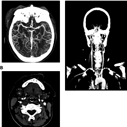 CTA of the head and neck via i.o. access.