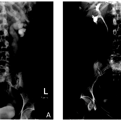 Preoperative and postoperative intravenous pyelography of one patient.