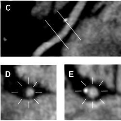Different plaque types, as seen by cardiac computed tomography.