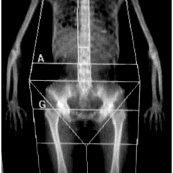 Regions of trunk fat, android (A) fat, and arm and leg fat as assessed ...