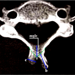Defined and measured dimensions of the spinous processes–a zoomed view.