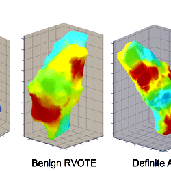 3D color maps of fractionation measured pre-ERP-distribution in Normal ...