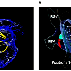 Online webinar training to analyse complex atrial fibrillation maps: A ...