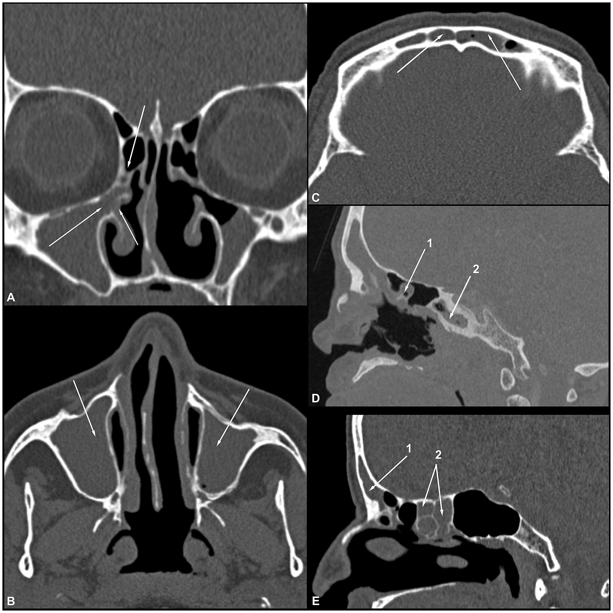 Ethmoid Air Cells Opacified