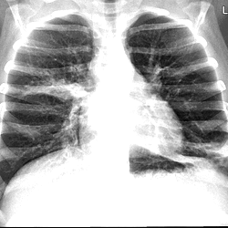 Linear opacities and regions of consolidations in the middle right and ...