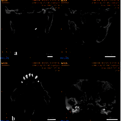 CT slices through the level of the maxilla and mandible.