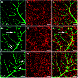 Retinal vascular abnormalities are accompanied by reactive gliosis.