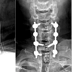 A new anatomical approach of cervical lateral mass for cervical pedicle ...