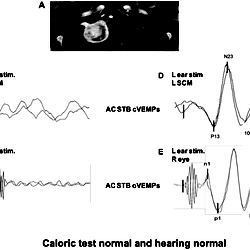 Clinical utility of VEMP test in vestibular schwannoma patients.