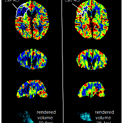 Whole brain CTP mismatch assessment in a 79 yrs old female who ...