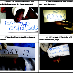 Figure 2 shows photographs of selected adverse events with the PrePex ...