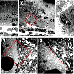 Neovessels that interface with the RPE form characteristic ...