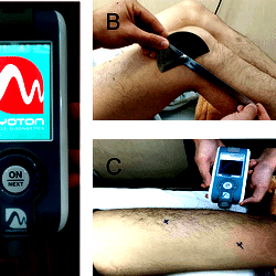 The MyotonPRO measurement technique.