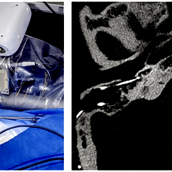 Robotic middle ear access for cochlear implantation: First in man - Fig 2