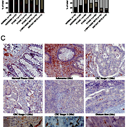 HRG detected by IHC of CRC tumor tissue arrays.