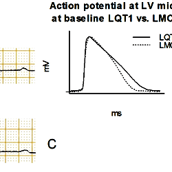 Baseline ECG and monophasic action potentials (MAP) in LQT1 and LMC ...