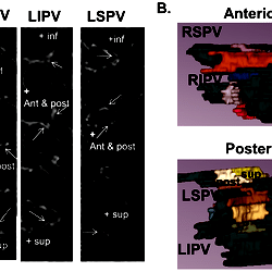 16 segment model showing the 4 regions evaluated around each pulmonary ...
