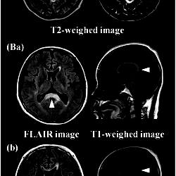 Focal atrophy on follow-up brain MRI.
