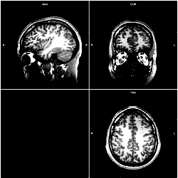 Targeting the dorsolateral PFC, depicted at the cross, for rTMS with a ...