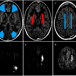 Watershed territories, on sequence Fluid Attenuated Inversion Recovery ...