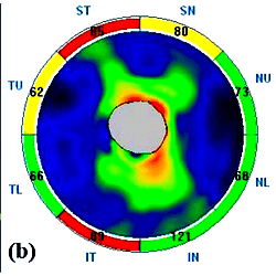 Representative image of an eye in the preperimetric glaucoma group ...